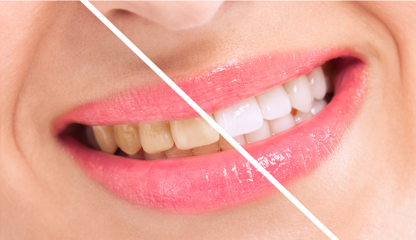 Your Lincoln Dentist Enhances Smiles With Teeth Whitening Olberding